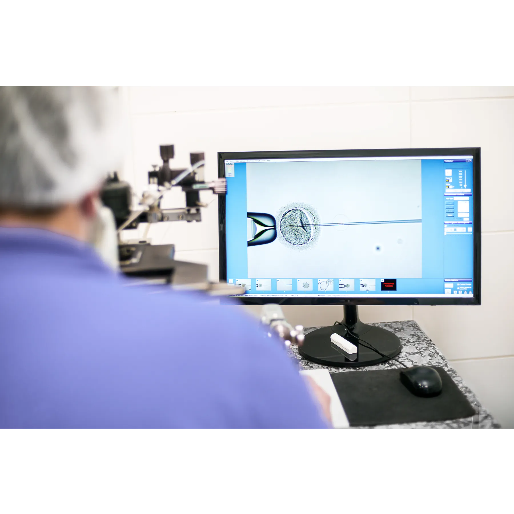 Testicular Sperm Extraction In Atlanta, GA | Advanced Urology