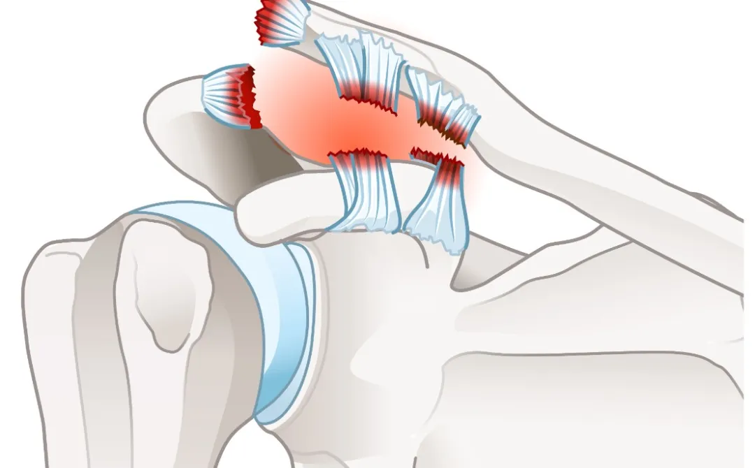 Separated Shoulder | Orthopaedic Specialists of Austin