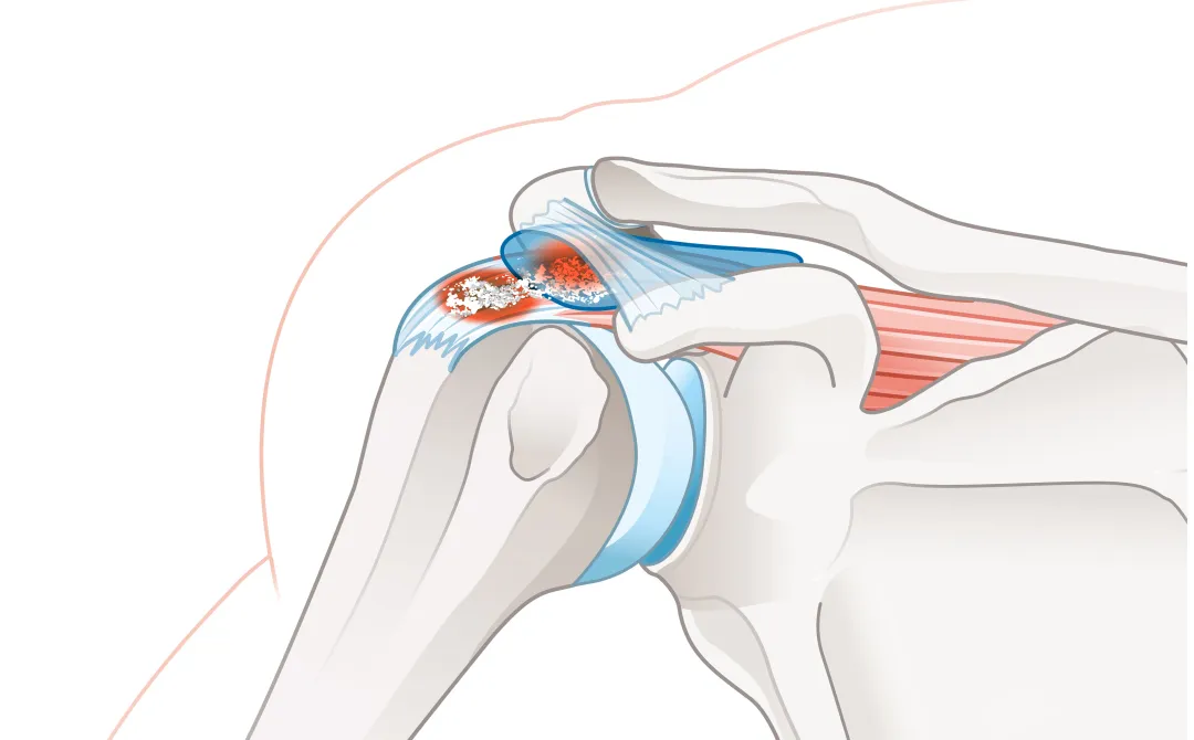 Bursitis Treatment | Orthopaedic Specialists of Austin