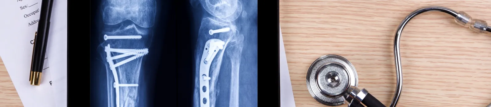 Maxframe Autostrut Device for Bone Deformities and Fractures | Pinnacle ...