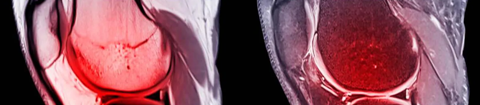 ACL Tears: Symptoms, Causes, & Treatment | Pinnacle Orthopaedics