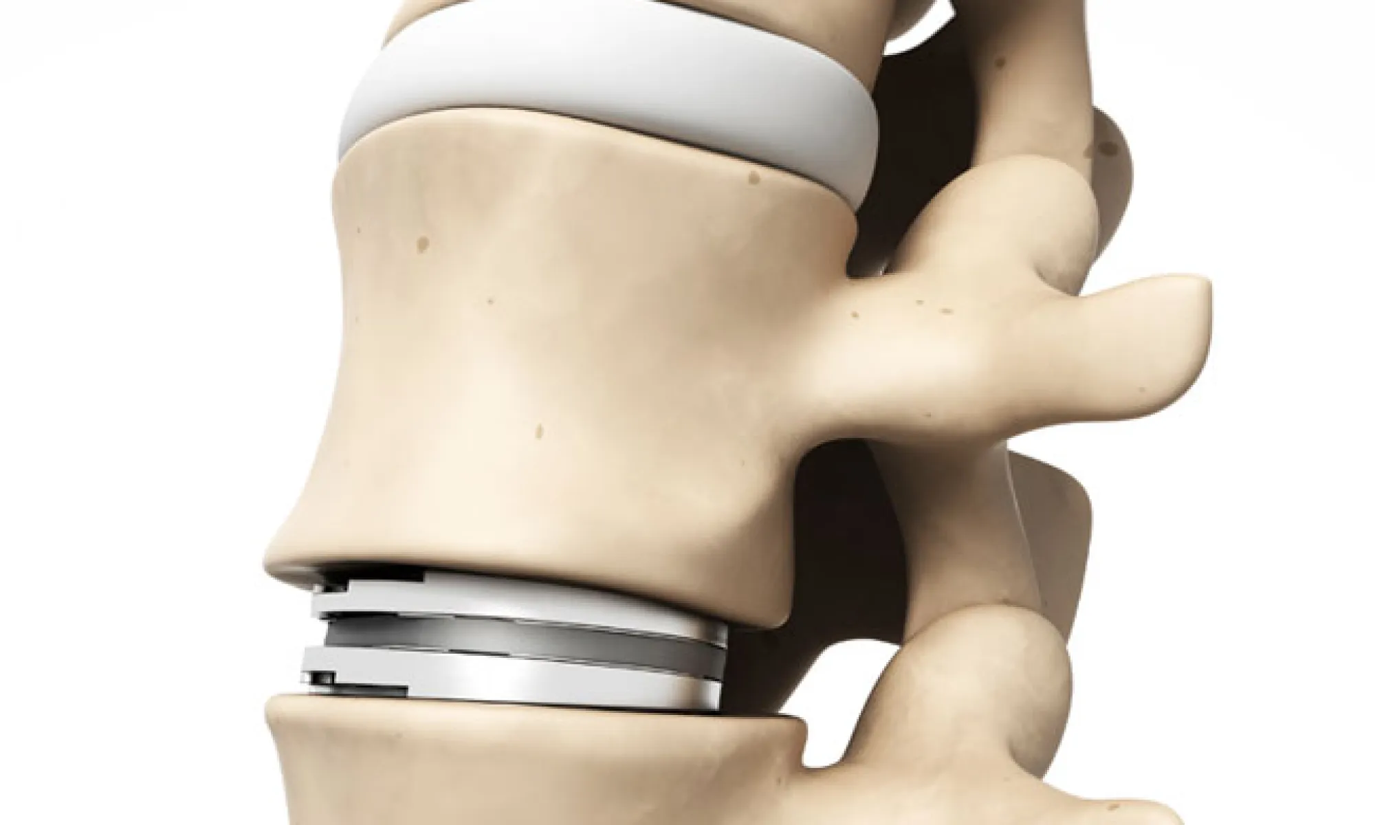 Body Weight and Disc Herniation - Proliance Orthopedic Associates ...