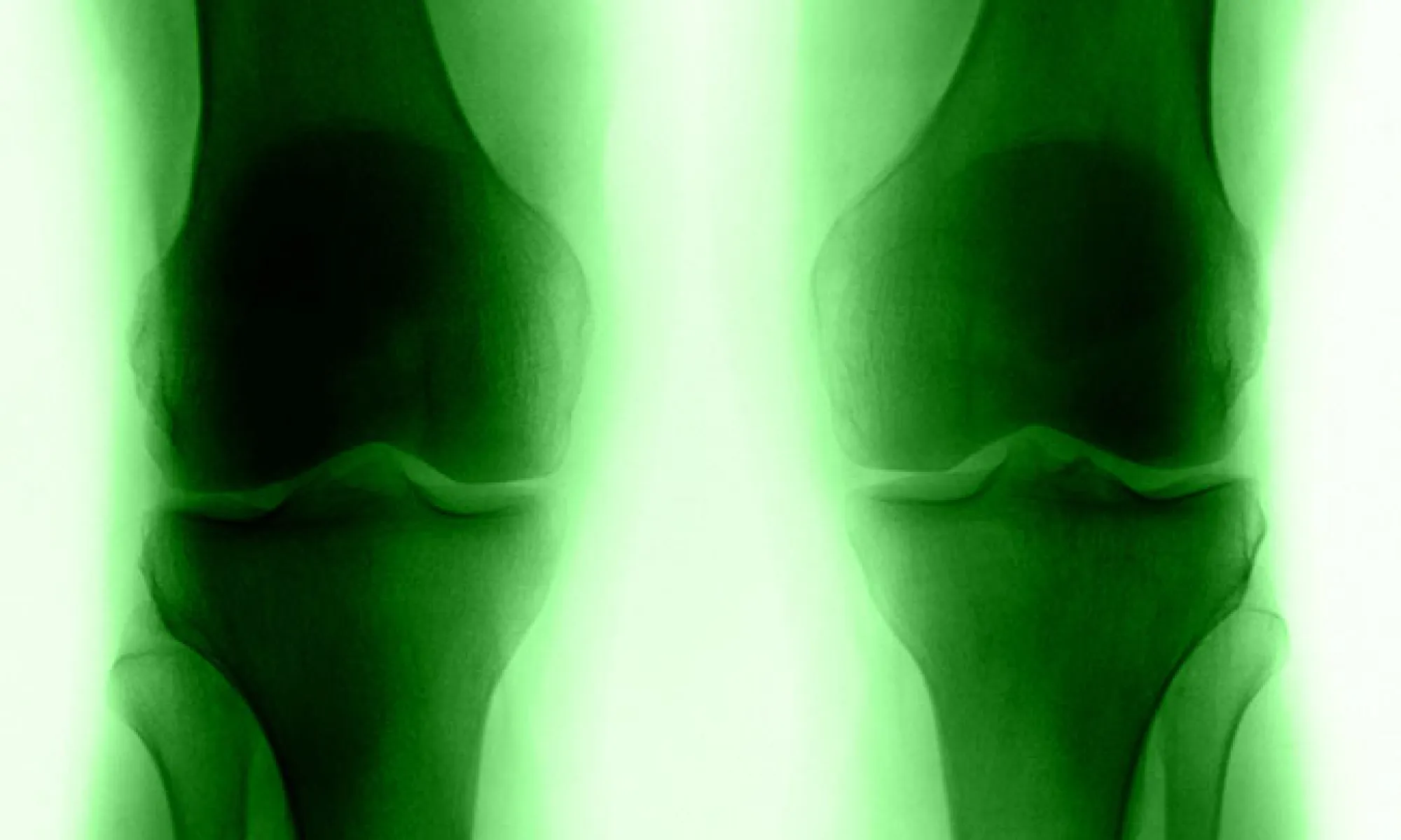 Shortening Joint Replacement Stays - Proliance Orthopedic Associates ...