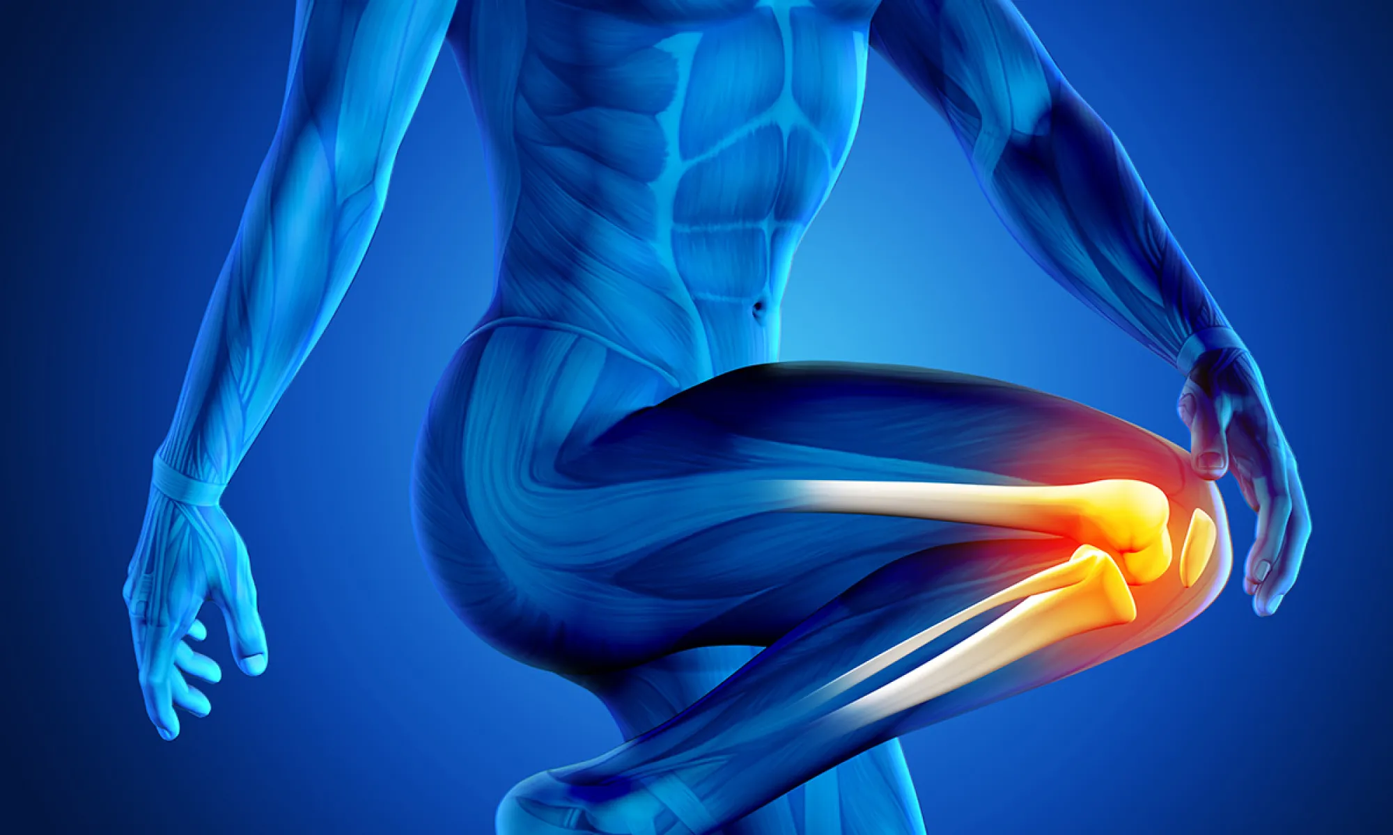 Knee Replacement Component Options | Proliance Orthopedic