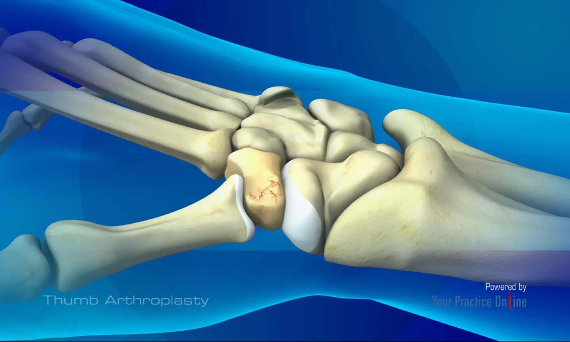 Thumb Arthroplasty | Proliance Orthopedic