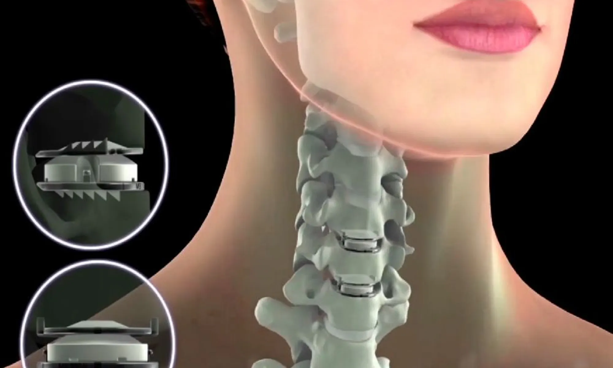 Cervical Disc Replacement | Proliance Orthopedic