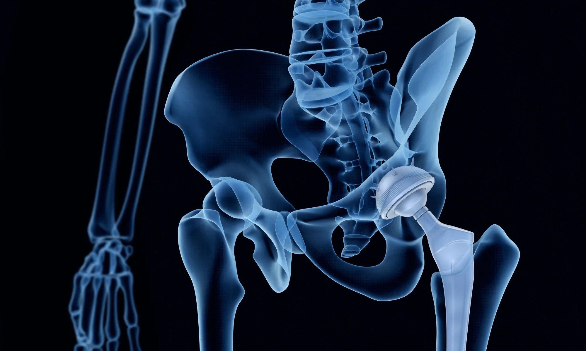 Know the outcomes of your total joint implant system - Proliance ...