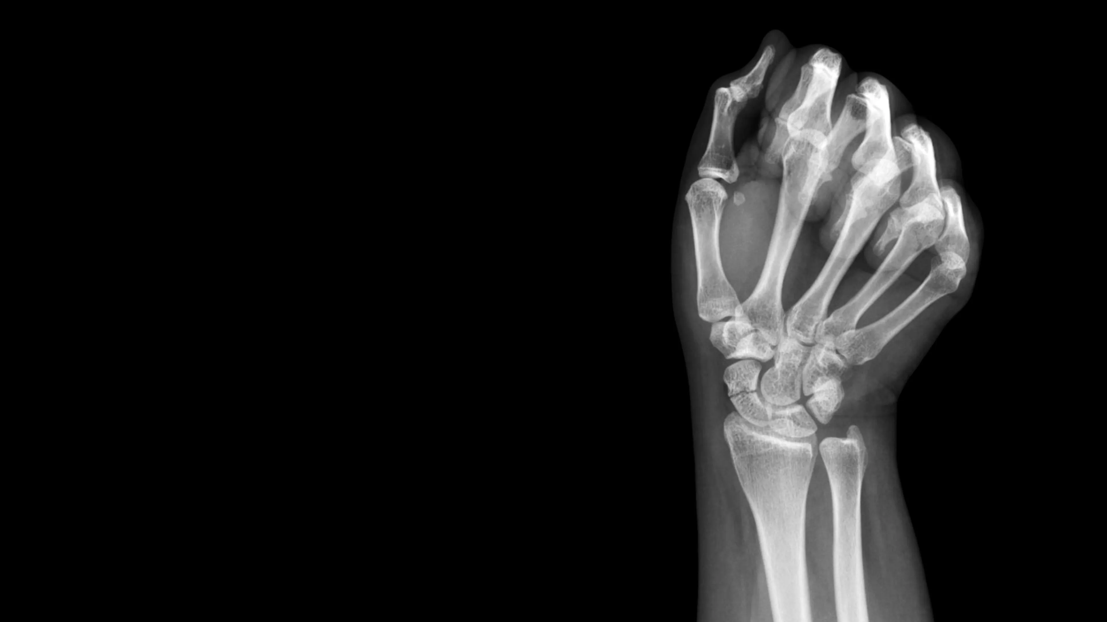Scaphoid Fractures | OrthoSouth