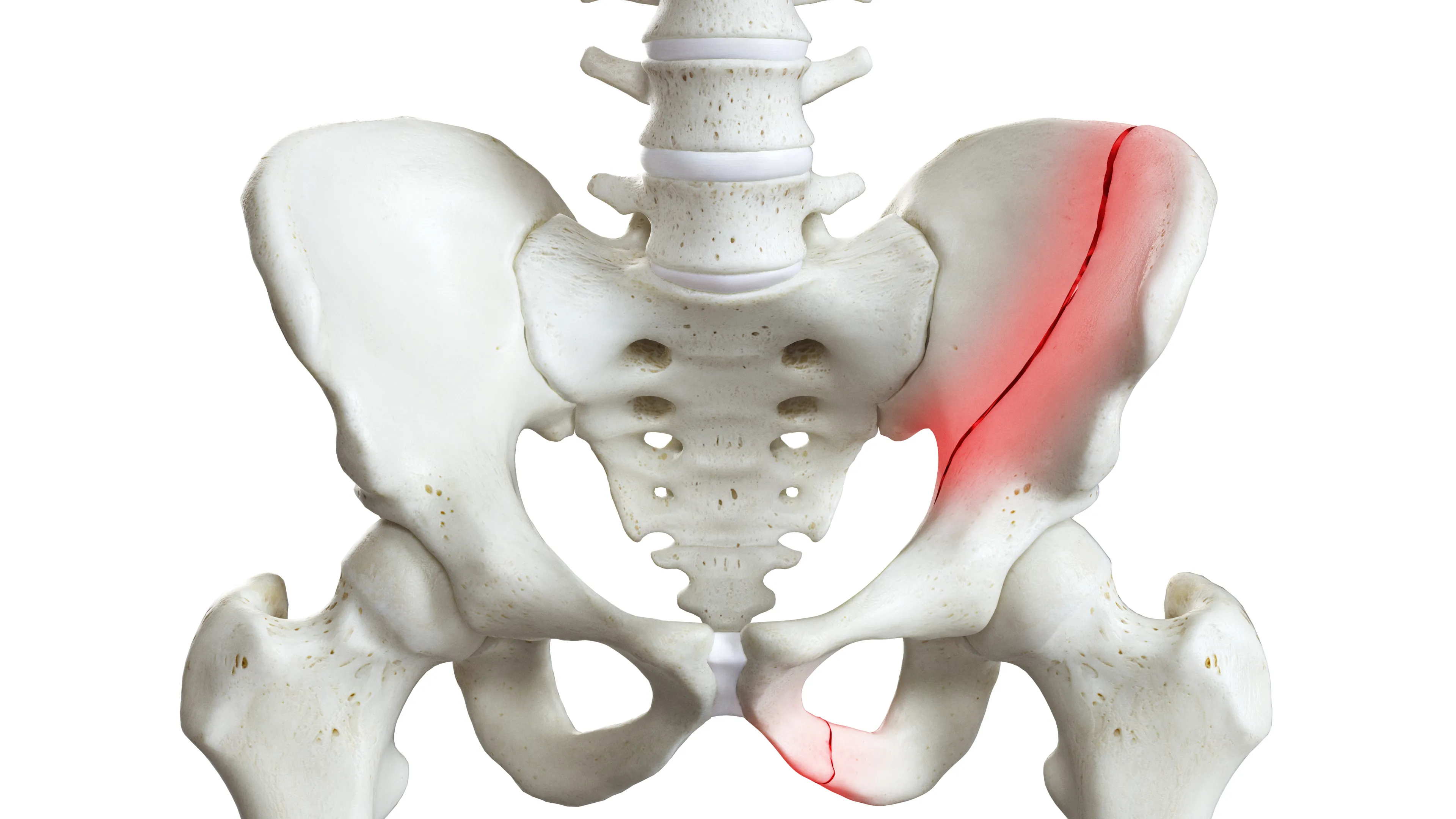 Pelvis and Acetabulum Fractures | OrthoSouth
