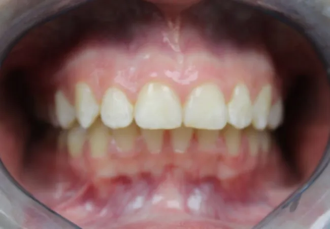 Smile Gallery in Boynton Beach, FL | Healthy Dental Expressions