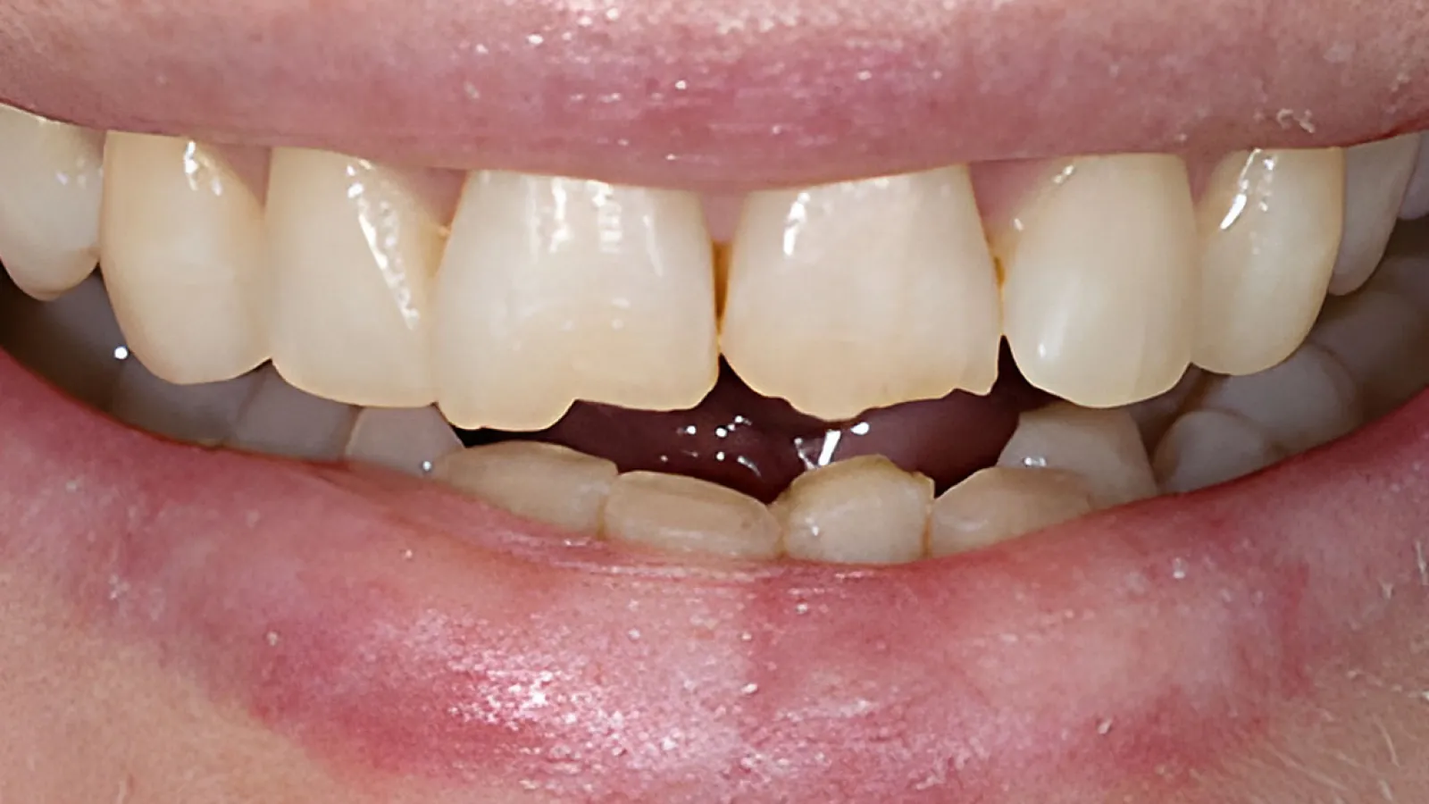Smile Gallery Parkland, FL | Dedicated Dental Group Parkland ...