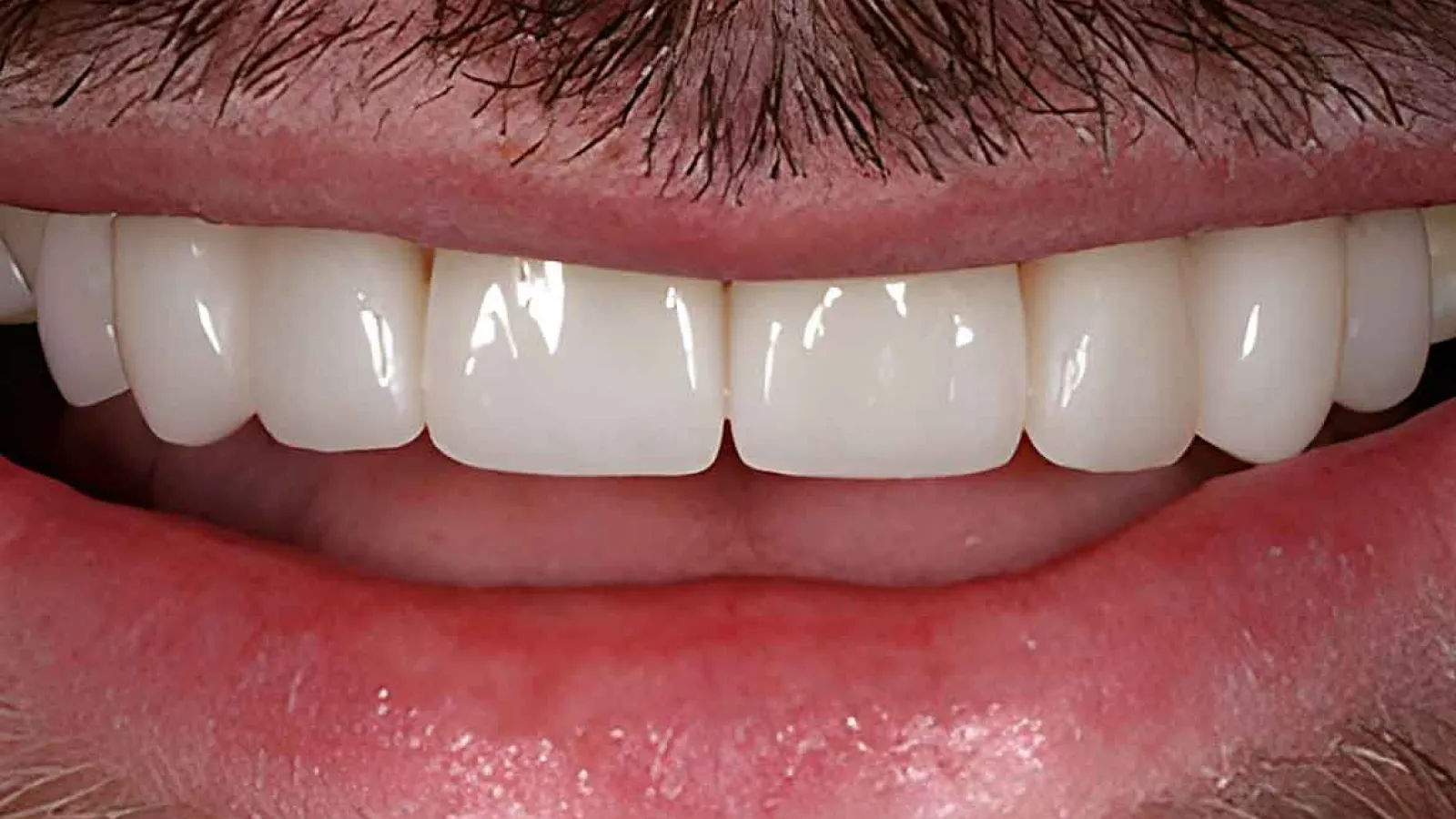 Smile Gallery Parkland, FL | Dedicated Dental Group Parkland ...