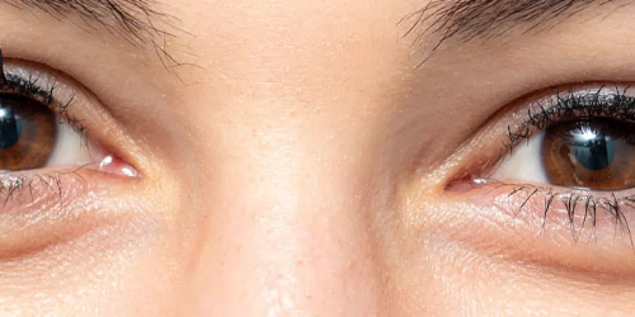 Save on Facial Injectables in Atlanta, GA