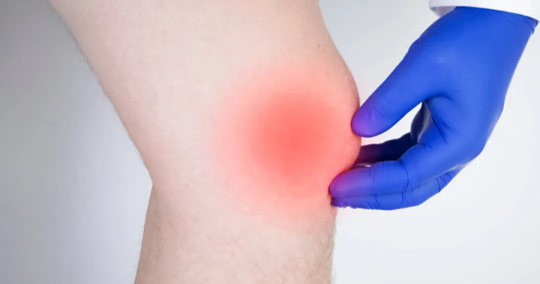 Knee Bursitis Specialist Near Me in Lexington, KY | Knee Doctors ...
